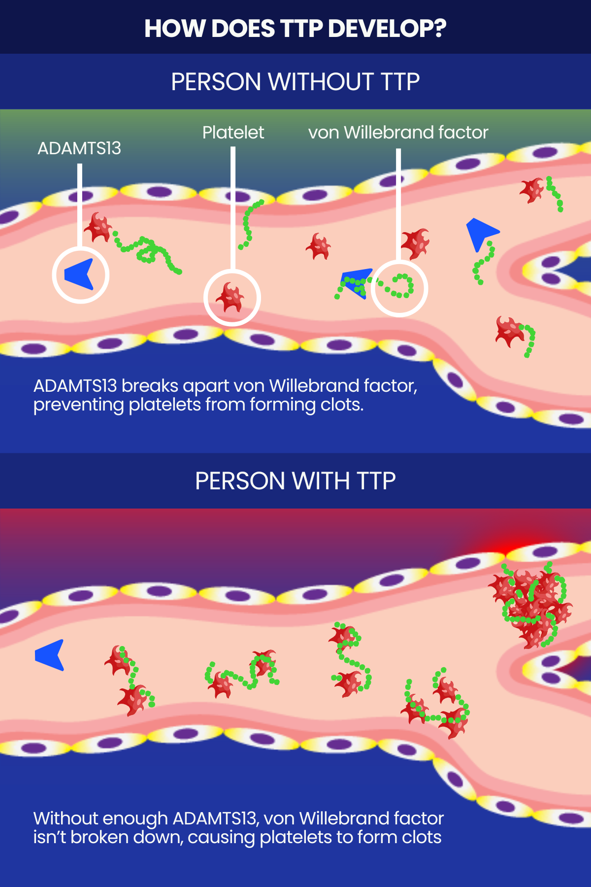 Thrombotic thrombocytopenic purpura | Bleeding Disorders News